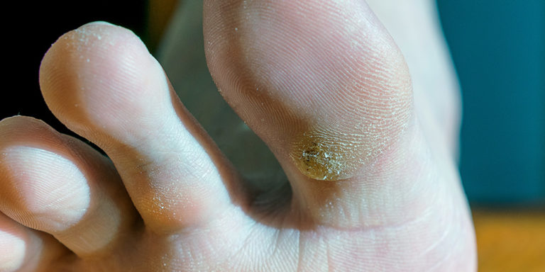 All About Warts | Brockton and Area Family Health Team
